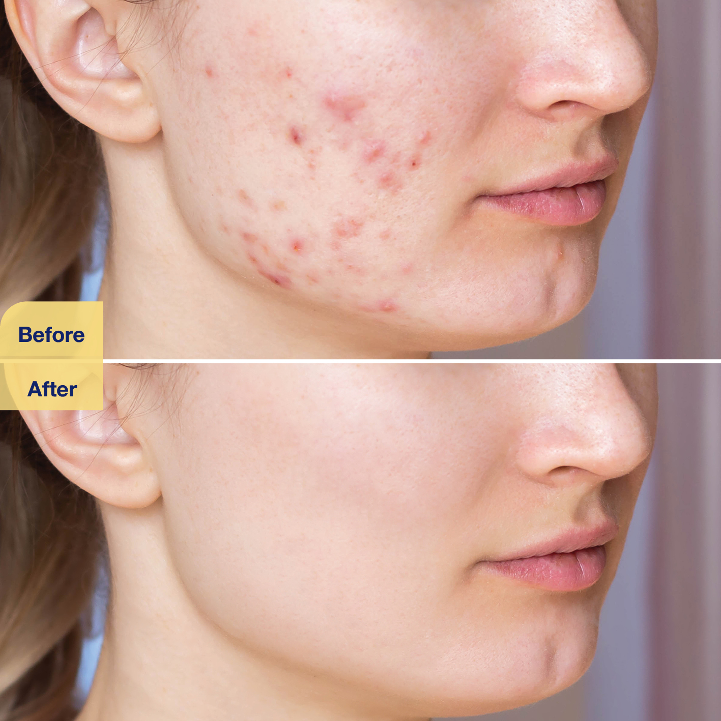 Acne treatment | Skin cancer screening & treatment Kuwait