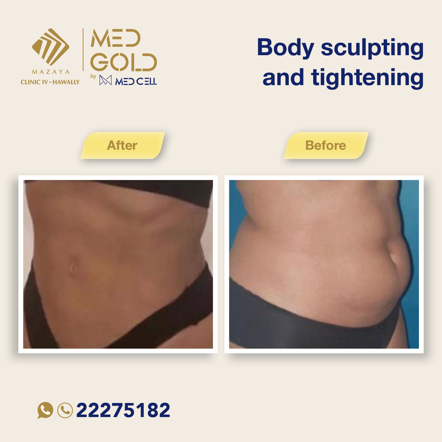 Rhinoplasty | Blepharoplasty | Brazilian butt lifts Kuwait